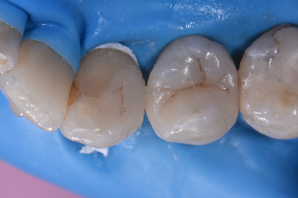 Marginal leakage on old composite fillings