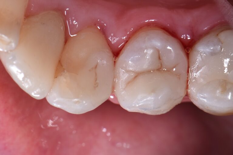 Marginal leakage on old composite fillings
