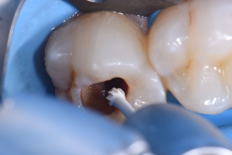 Komet Cerabur removal of arrested caries Komet Cerabur removal of ...