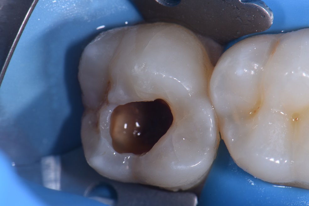 Komet Cerabur removal of arrested caries Komet Cerabur removal of ...