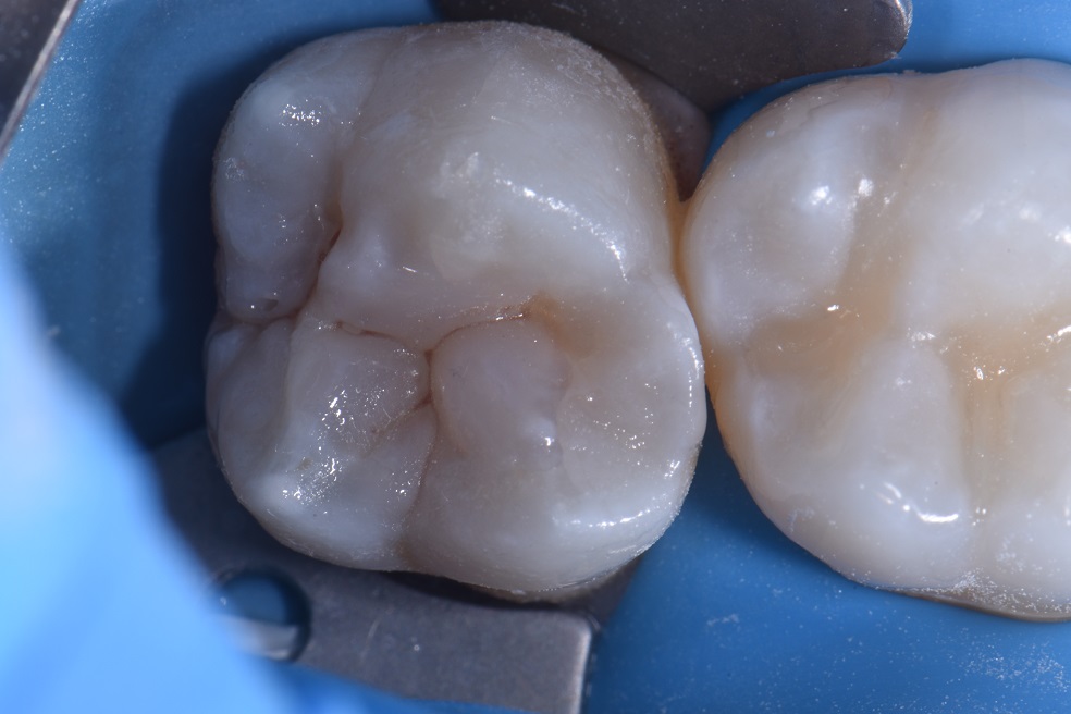 Komet Cerabur removal of arrested caries Komet Cerabur removal of ...