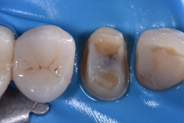 IPS e-max full coverage MT ingot