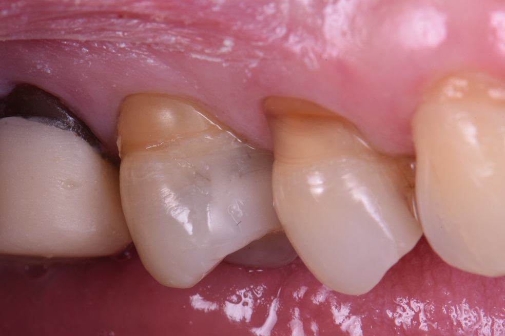 Deep Cervical Abrasion Lesions Deep Cervical Abrasion Lesions