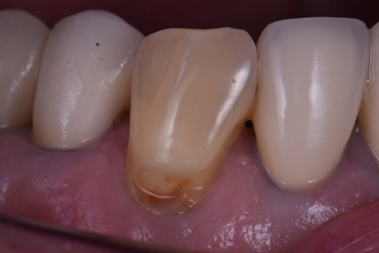 Creating Invisible Class V restorations Creating Invisible Class V ...