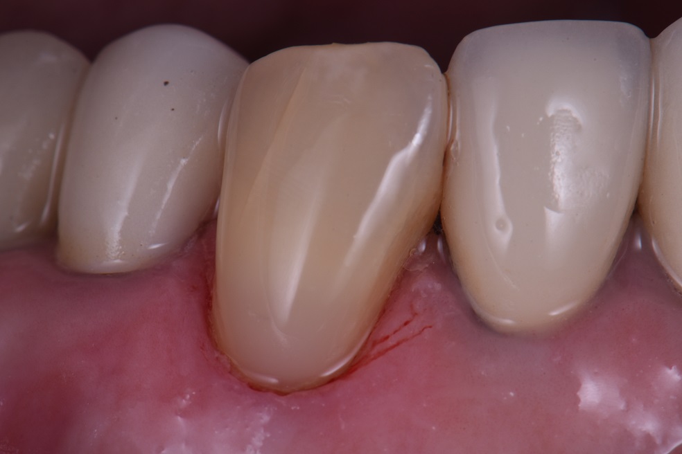 Creating Invisible Class V restorations Creating Invisible Class V ...