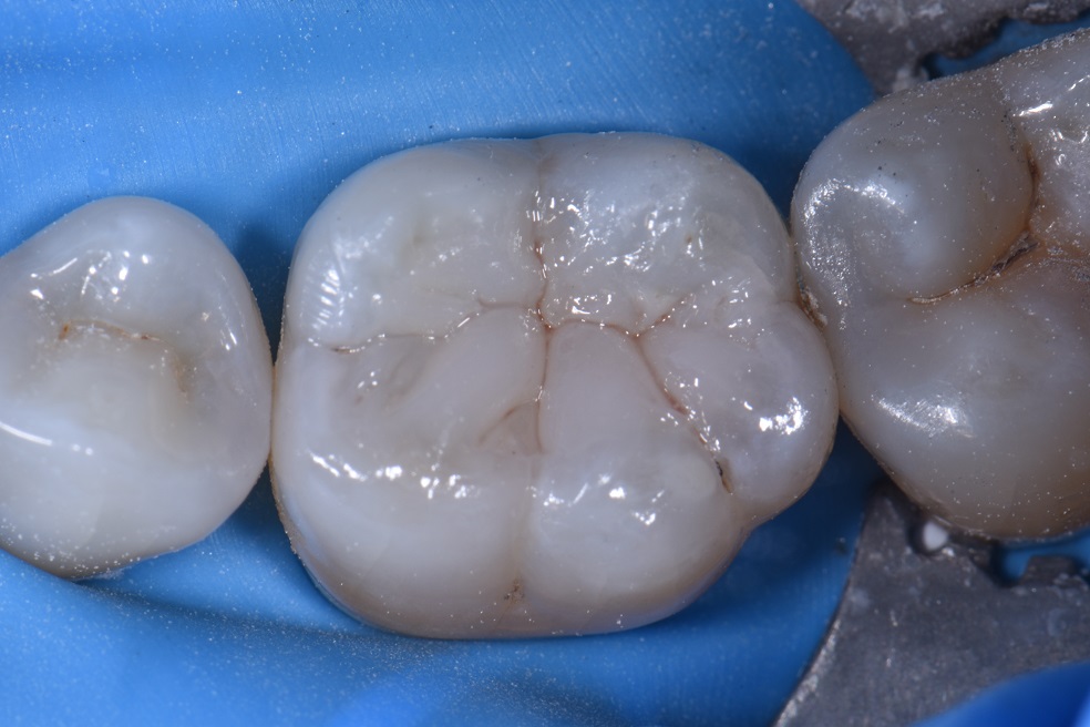 Dental Amalgam Replacement Dental Amalgam Replacement