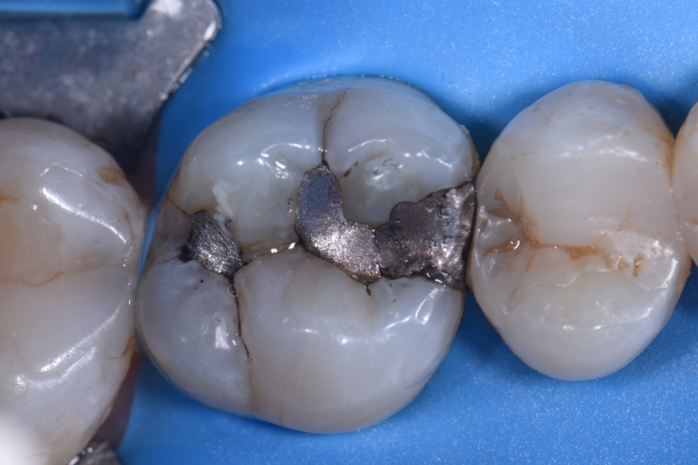 Cracked Amalgam Teeth Cracked Amalgam Teeth