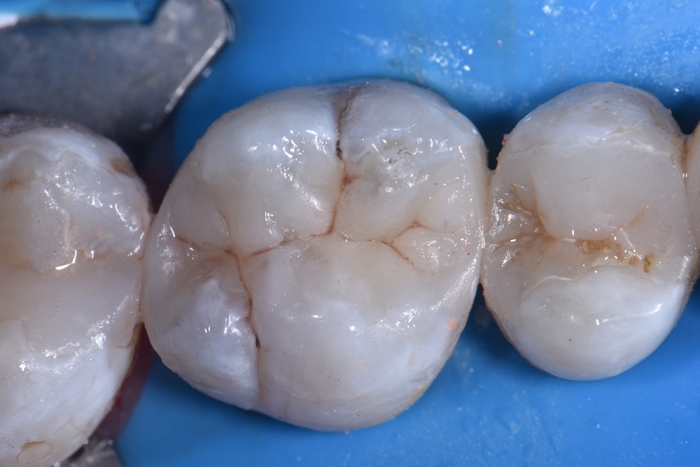 Cracked Amalgam Teeth Cracked Amalgam Teeth