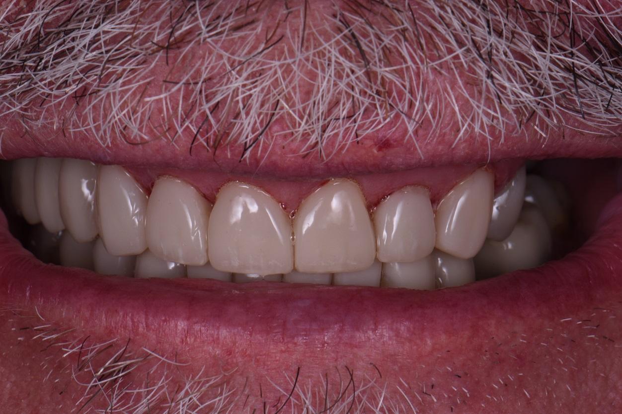 Transitional Bonding to Stabilize Dental Wear