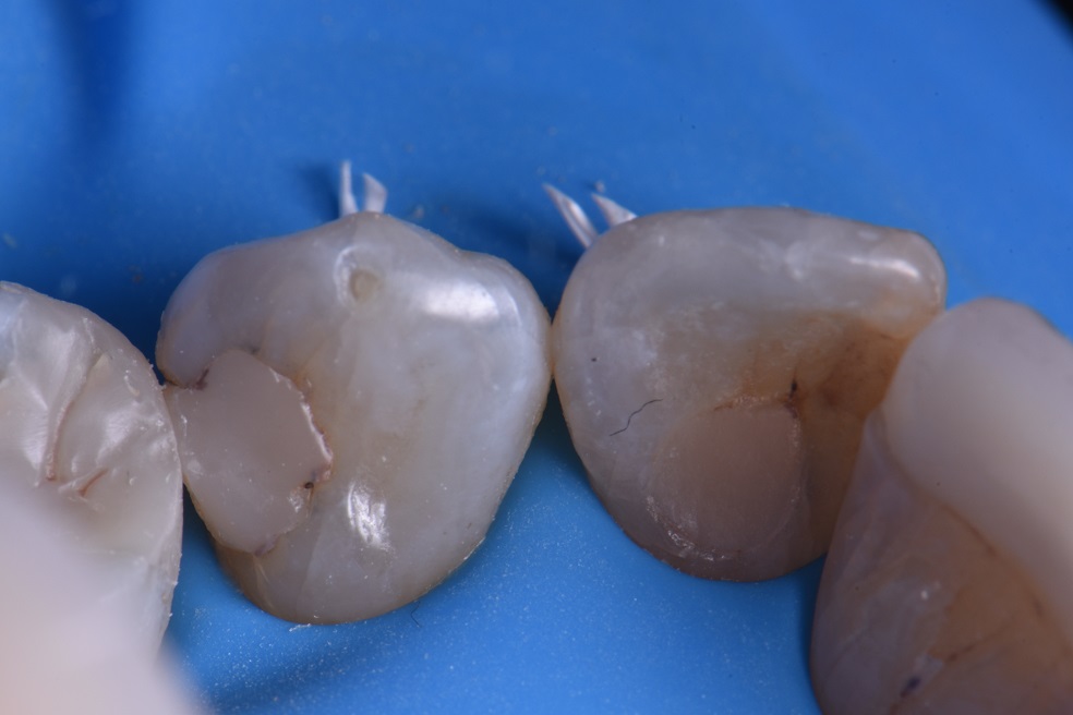Palatal Anatomy is Important Palatal Anatomy is Important