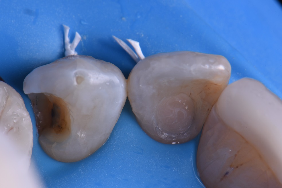 Palatal Anatomy is Important Palatal Anatomy is Important