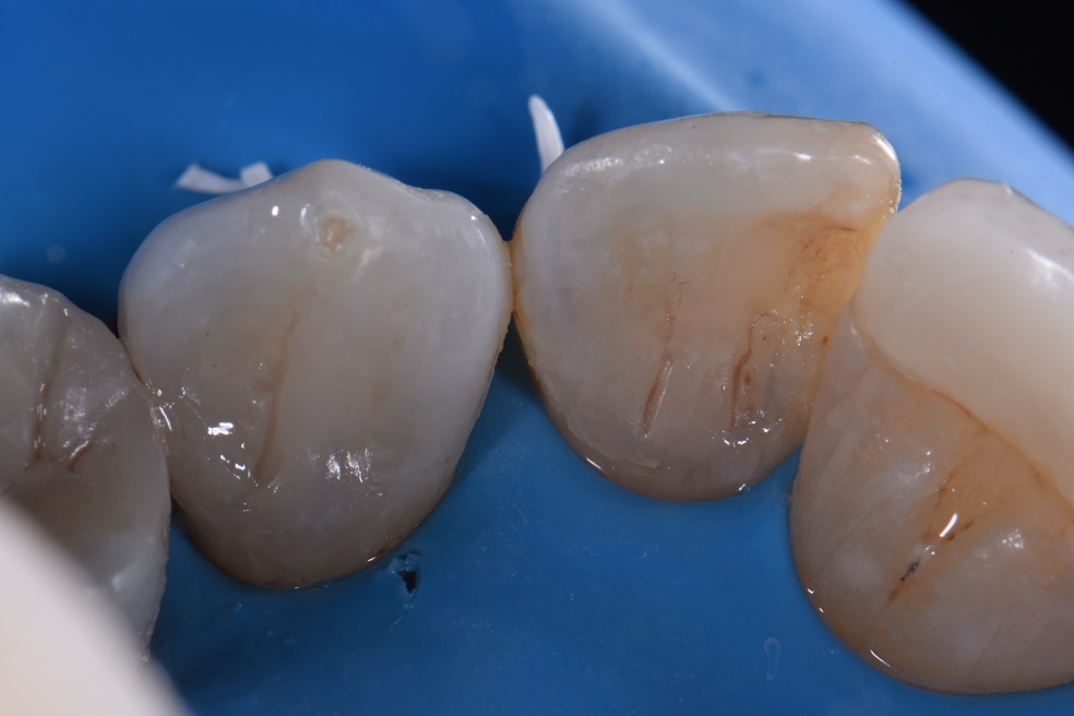 Palatal Anatomy is Important Palatal Anatomy is Important