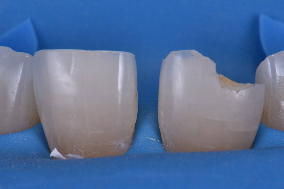 Dental Trauma on a dentist’s front tooth Dental Trauma on a dentist's ...