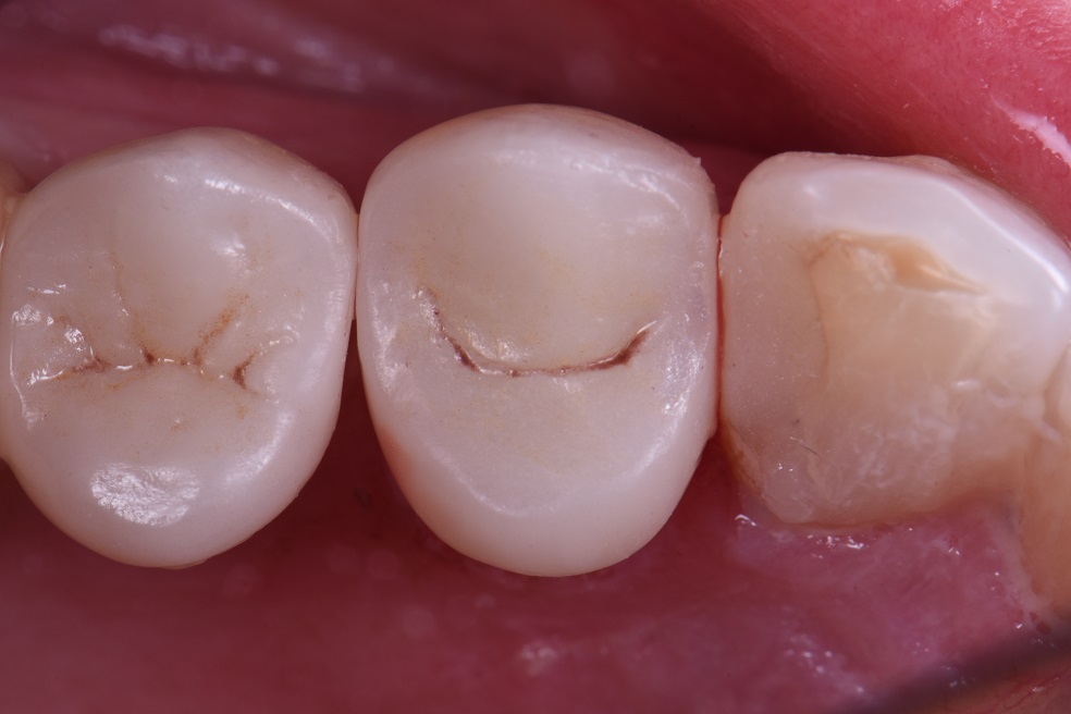 IPS e-max full coverage MT ingot