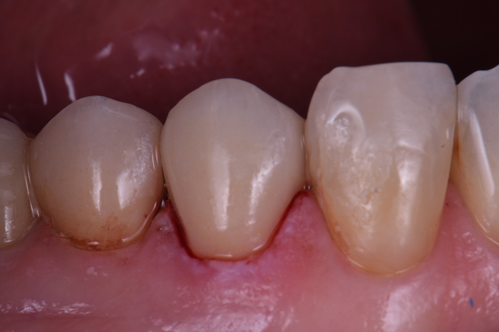 IPS e-max full coverage MT ingot