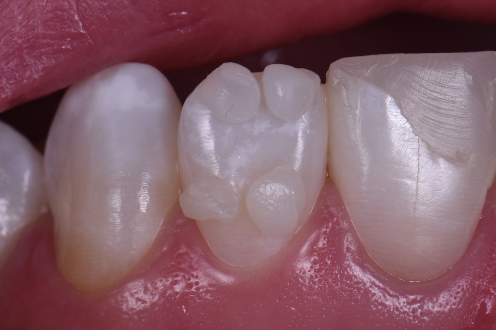 Composite Veneers post trauma Composite Veneers post trauma