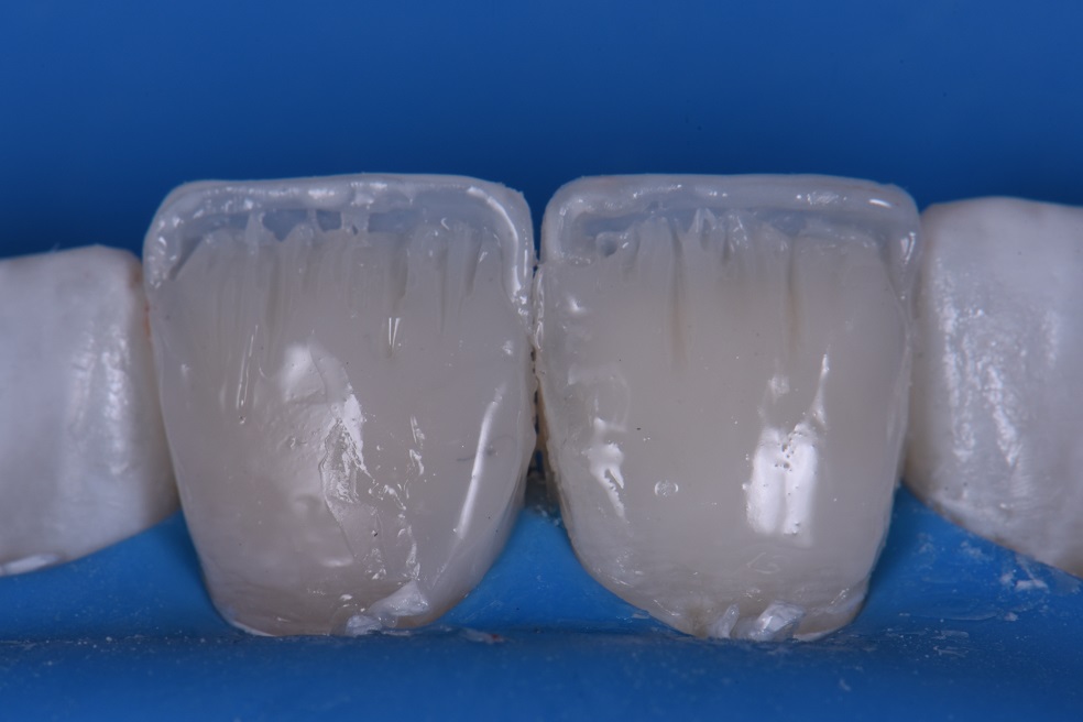 Composite Veneers post trauma Composite Veneers post trauma
