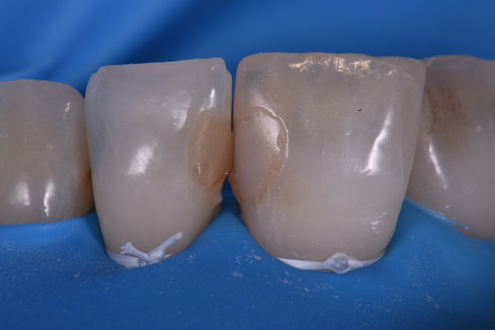 Class III cavities Class III cavities