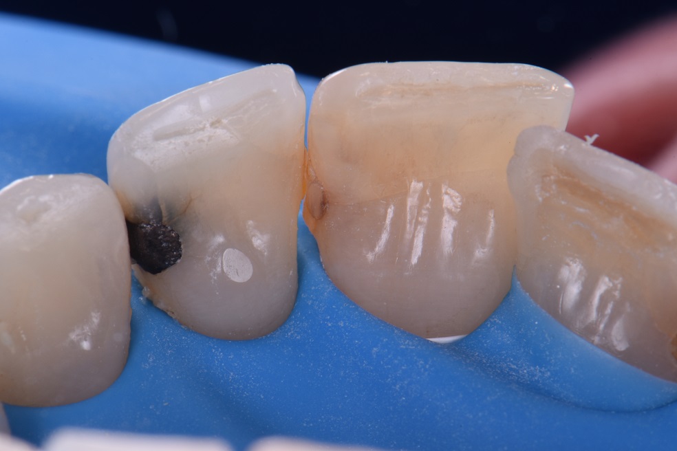 Class III cavities Class III cavities