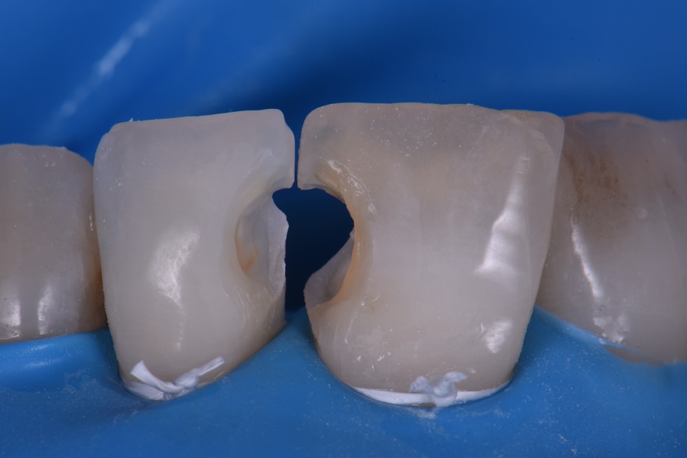 Class III cavities Class III cavities