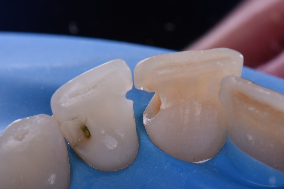 Class III cavities Class III cavities