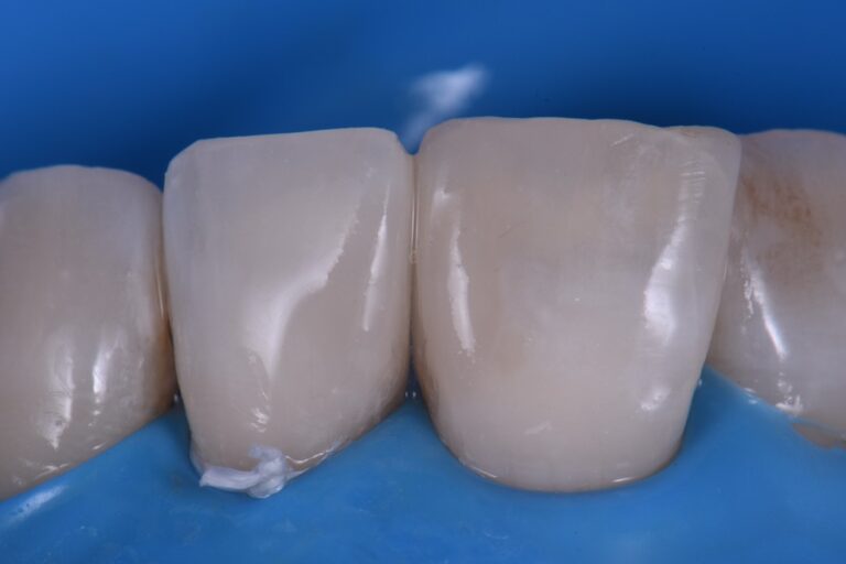 Class III cavities Class III cavities