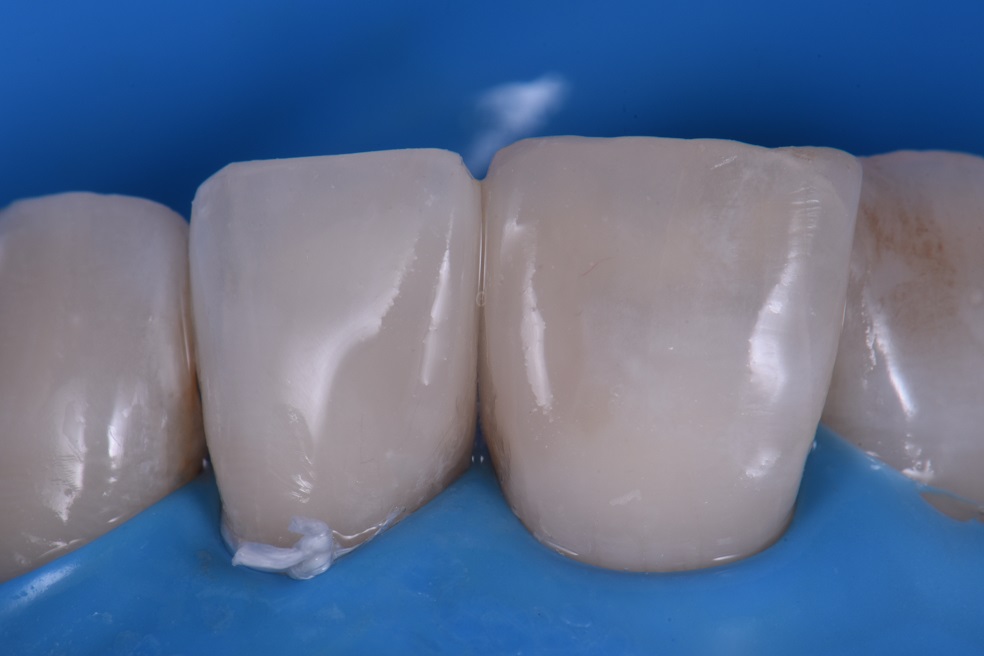 Class III cavities Class III cavities