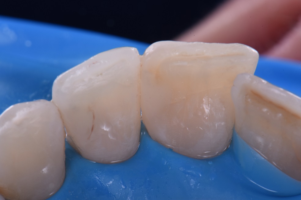 Class III cavities Class III cavities