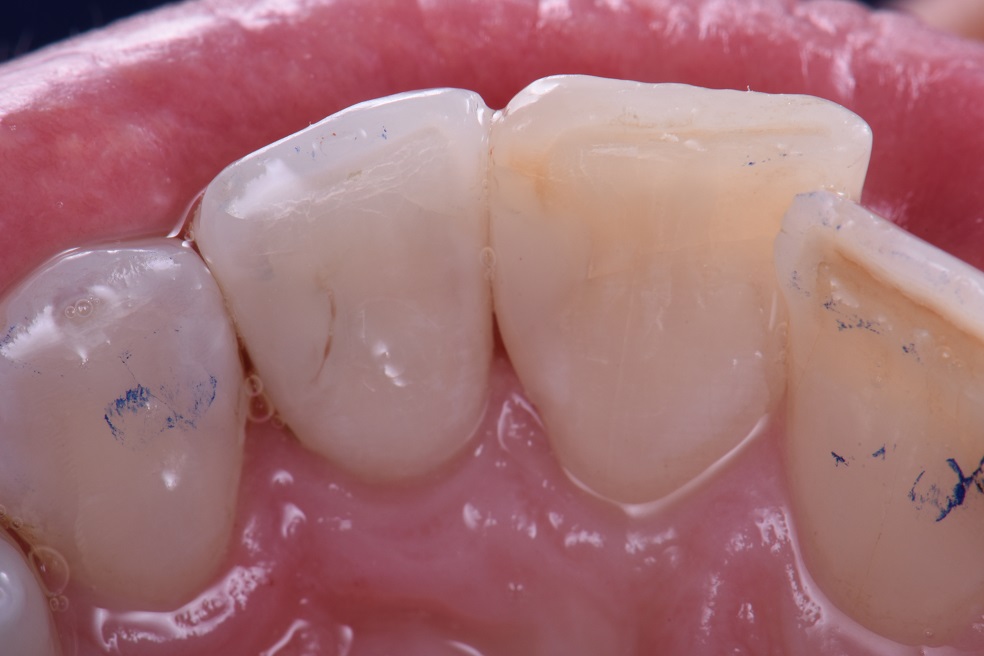 Class III cavities Class III cavities