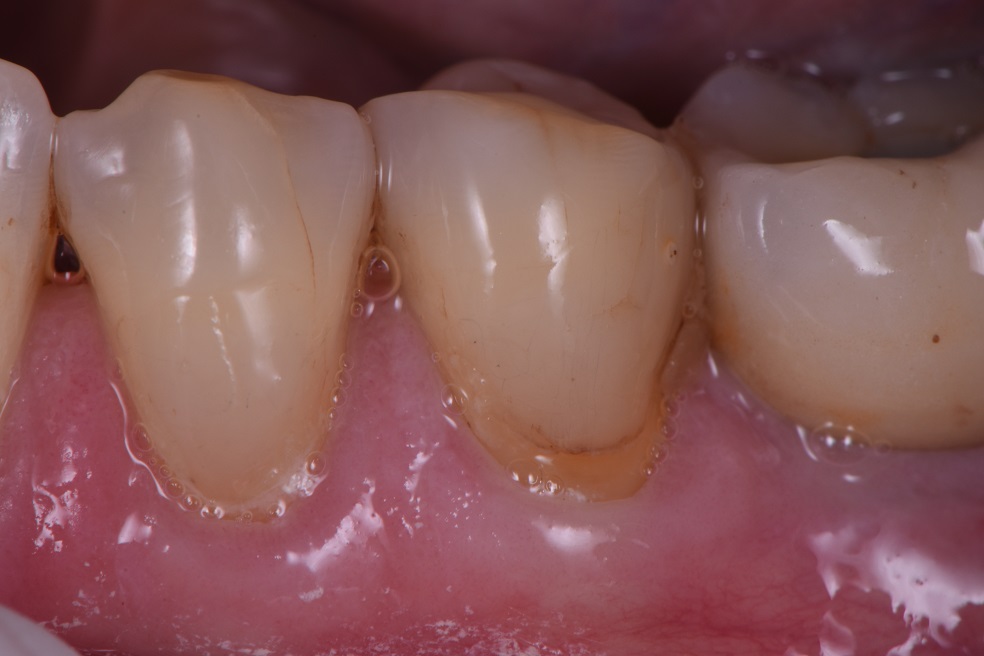 Class V Composite Restorations Class V Composite Restorations