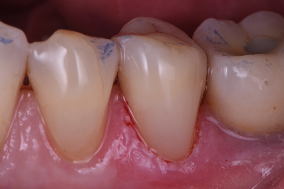 Class V Composite Restorations Class V Composite Restorations