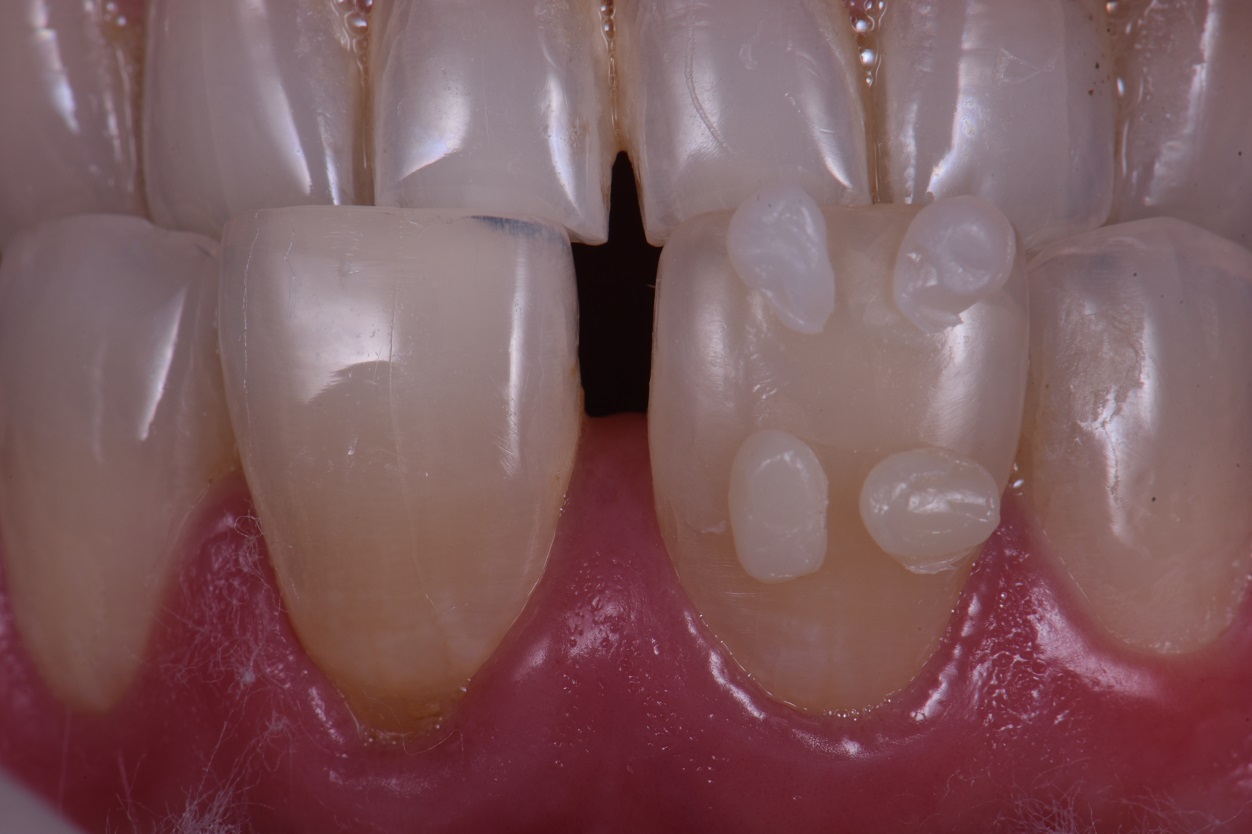 Dental Trauma on a dentist’s front tooth Dental Trauma on a dentist's ...