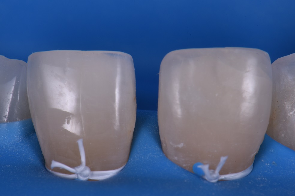 Dental Trauma on a dentist’s front tooth Dental Trauma on a dentist's ...