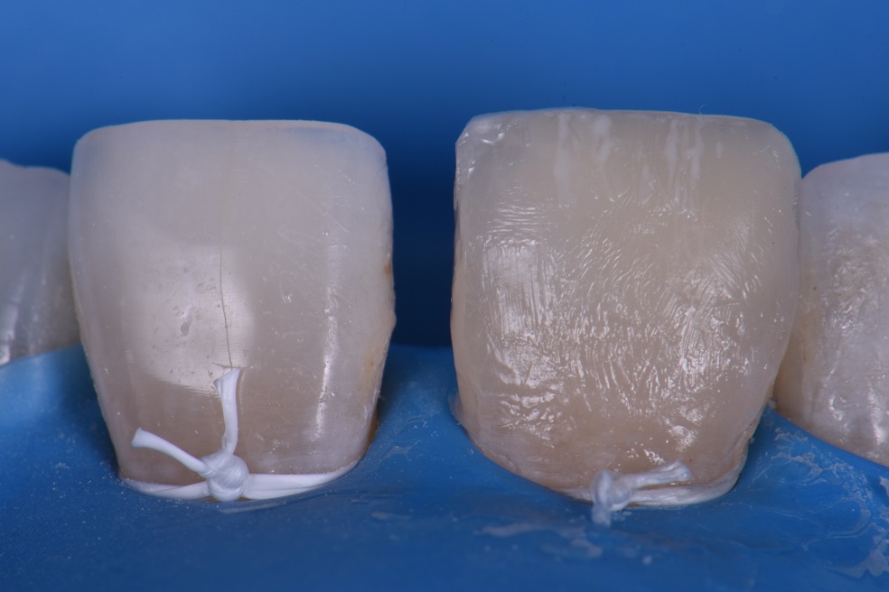 Dental Trauma on a dentist’s front tooth Dental Trauma on a dentist's ...