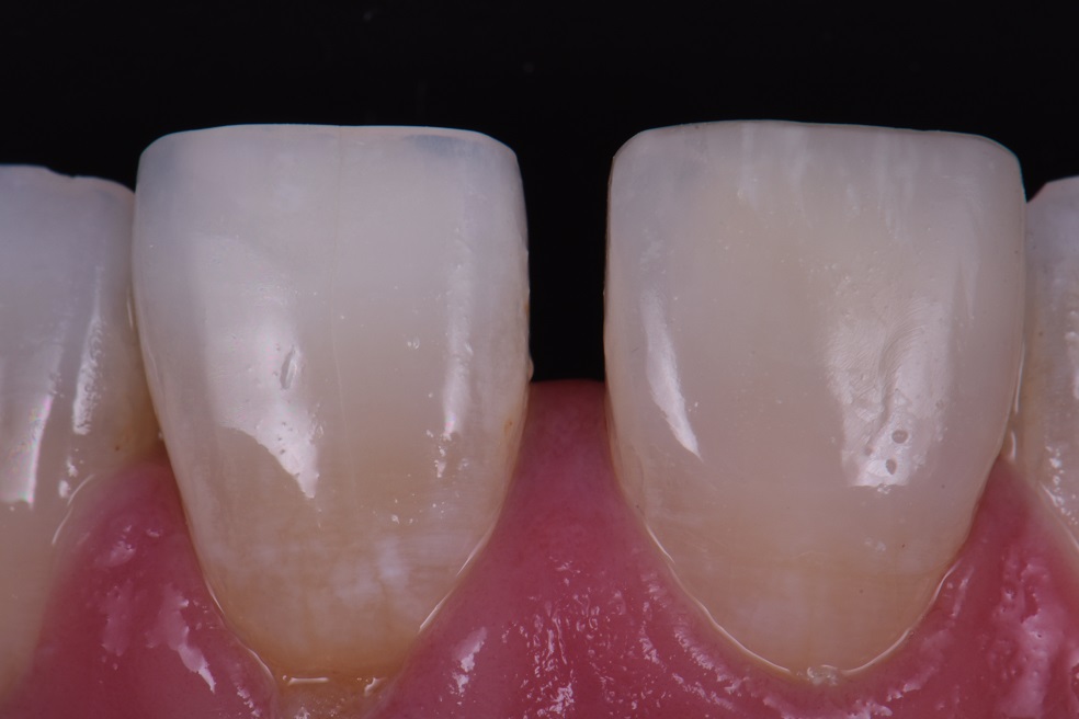 Dental Trauma on a dentist’s front tooth Dental Trauma on a dentist's ...