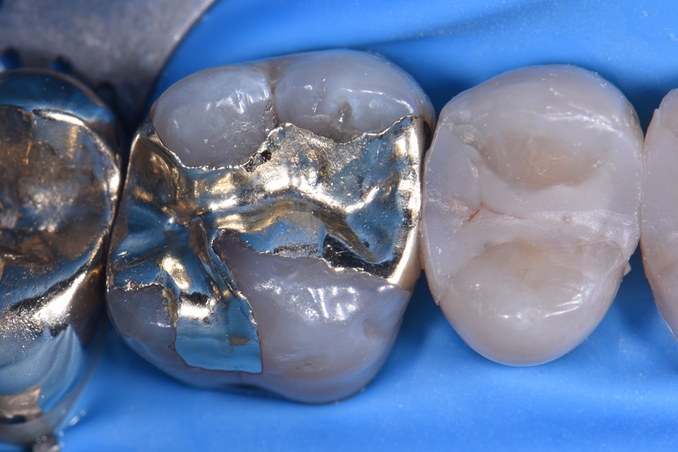 Replacing Gold Inlays