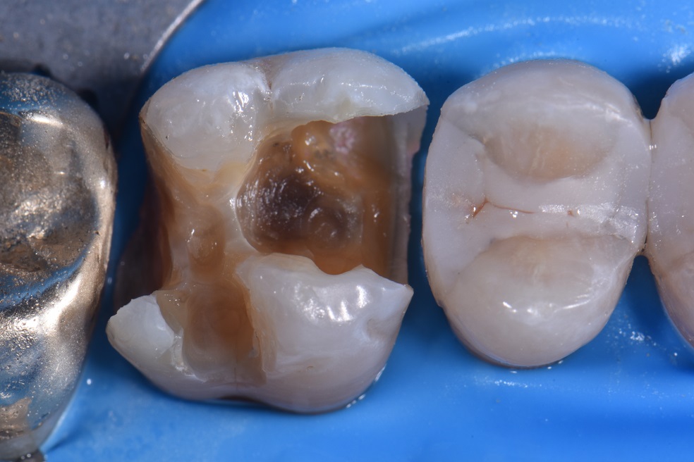 Replacing Gold Inlays