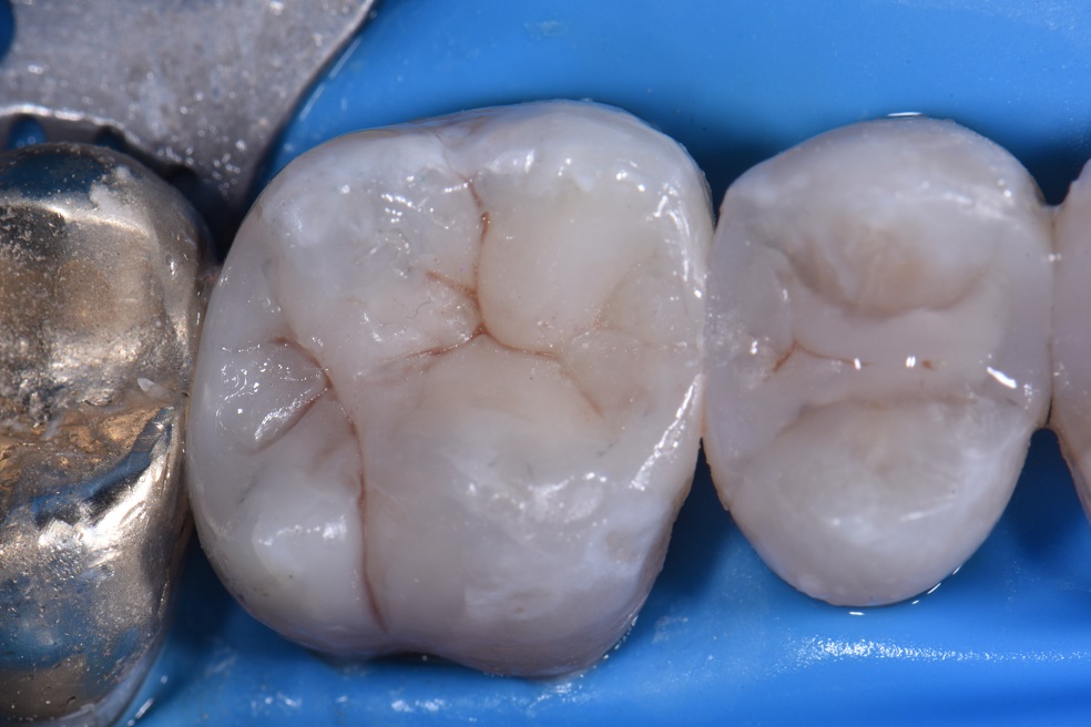 Replacing Gold Inlays