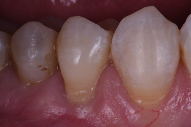 Class V abrasion sensitivity Class V abrasion sensitivity