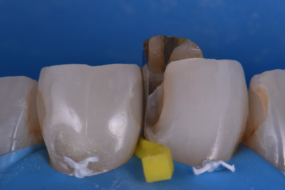 Garrison Fusion Anterior Class IV Garrison Fusion Anterior Class IV