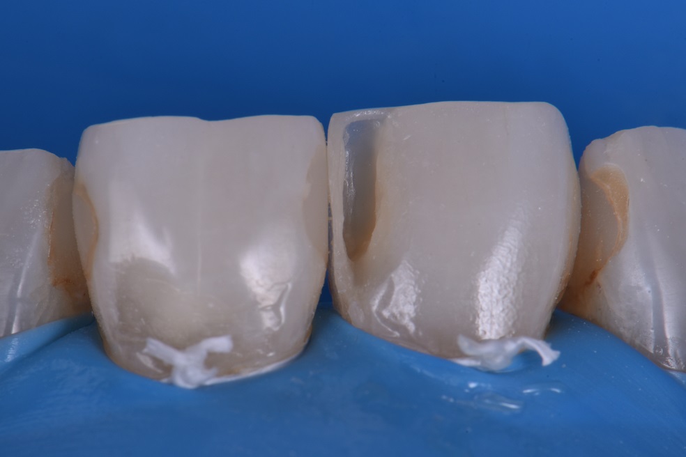 Garrison Fusion Anterior Class IV Garrison Fusion Anterior Class IV