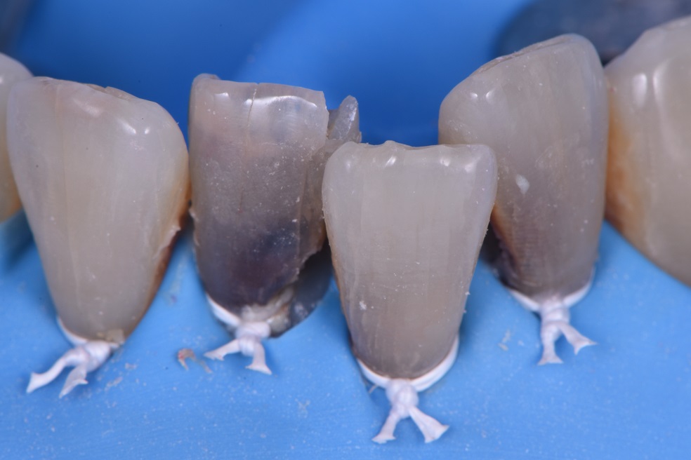 Rampant Decay Saving Hopeless Teeth Rampant Decay Saving Hopeless Teeth