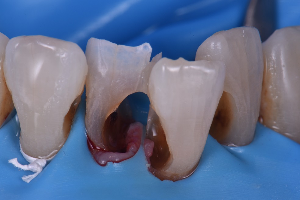 Rampant Decay Saving Hopeless Teeth Rampant Decay Saving Hopeless Teeth