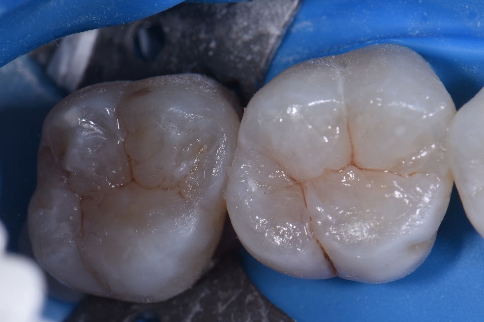 Beautiful Efficient Composite Restorations