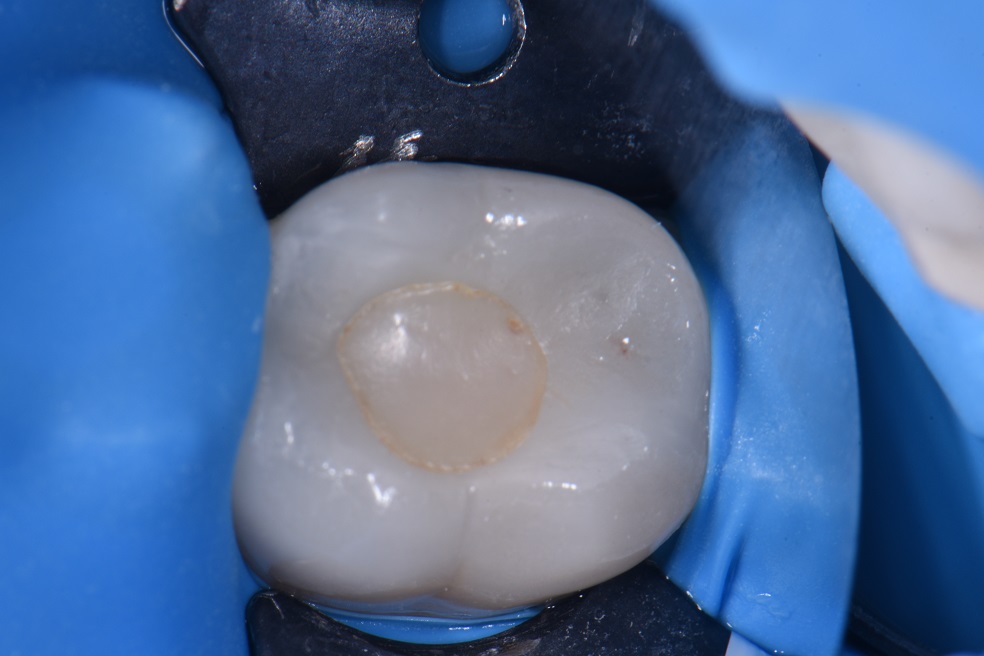 Endo Access Closures on a Crown Endo Access Closures on a Crown