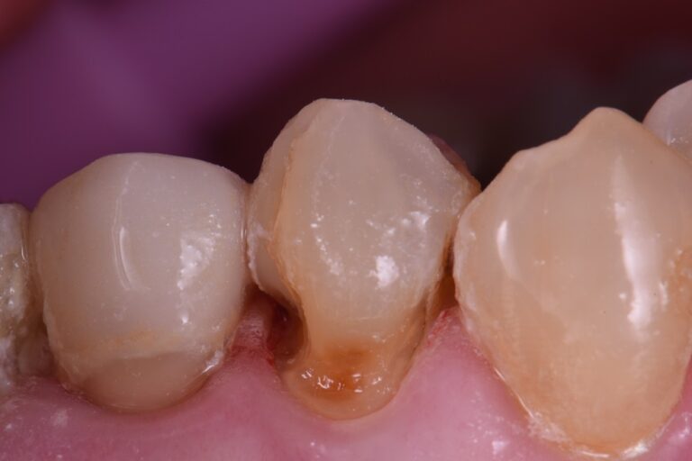 Deep Dental Cavities and Invisible Fillings