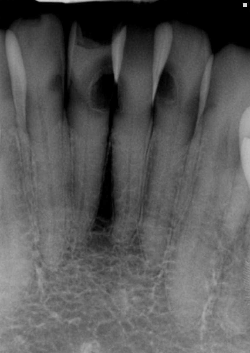 Rampant Decay Saving Hopeless Teeth Rampant Decay Saving Hopeless Teeth