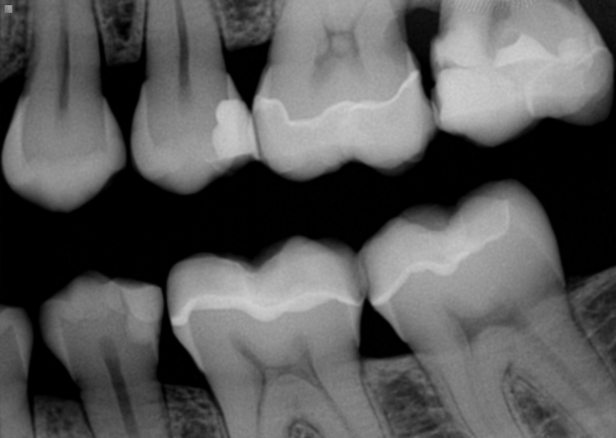 Deep Crestal level Dental Caries Deep Crestal level Dental Caries
