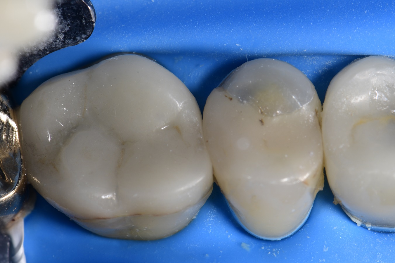 Minimally Invasive Crowns