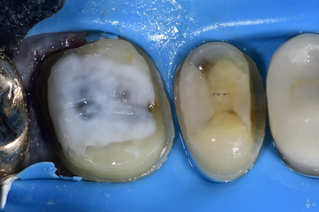 Minimally Invasive Crowns